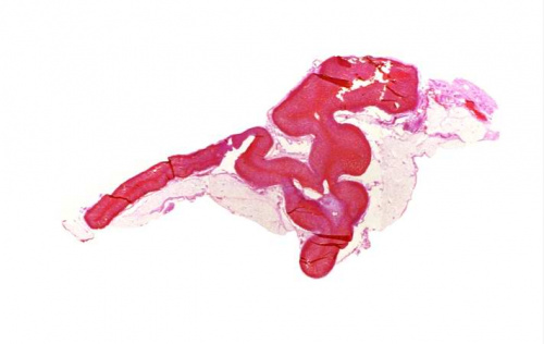 IPLab:Lab 13:Meningococcemia - Pathology Education Instructional Resource