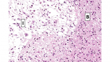 IPLab:Lab 3:Brain Infarction - Pathology Education Instructional Resource