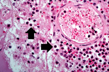 IPLab:Lab 9:Bacterial Meningitis - Pathology Education Instructional ...