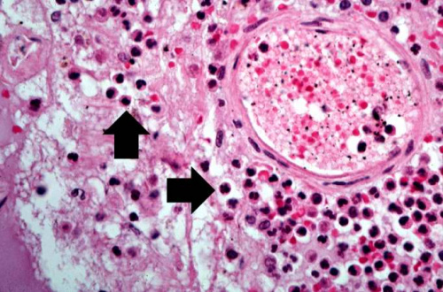 IPLab:Lab 9:Bacterial Meningitis - Pathology Education Instructional ...