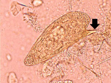 IPLab:Lab 11:Schistosomiasis - Pathology Education Instructional Resource