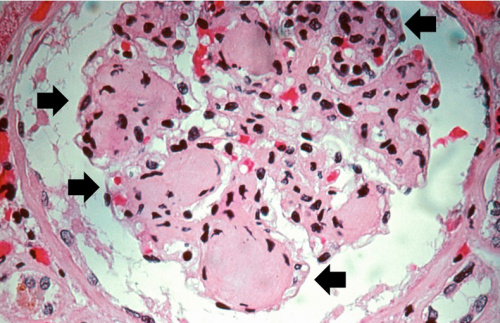 IPLab:Lab 5:Nodular Intercapillary Glomerulosclerosis - Pathology ...