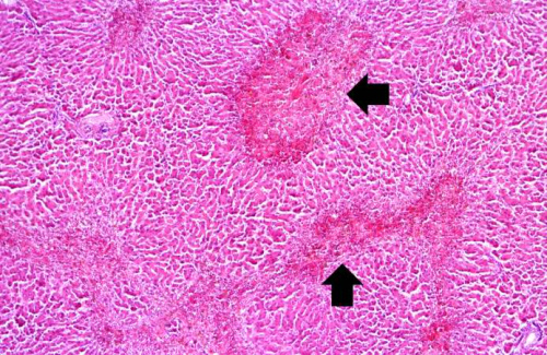 IPLab:Lab 12:Acetaminophen Toxicity - Pathology Education Instructional ...