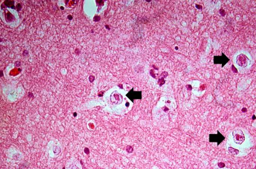 IPLab:Lab 8:HSV Encephalitis - Pathology Education Instructional Resource