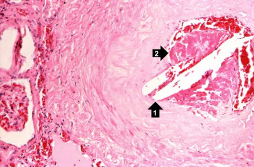 IPLab:Lab 4:Atheromatous Emboli - Pathology Education Instructional ...