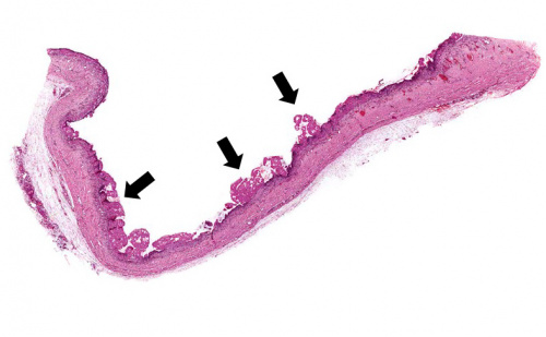 IPLab:Lab 3:Fibrinous Pericarditis - Pathology Education Instructional ...