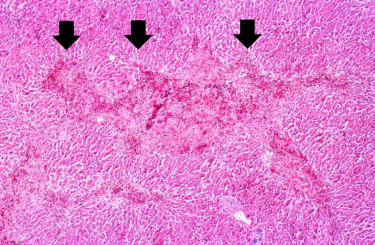 IPLab:Lab 12:Acetaminophen Toxicity - Pathology Education Instructional ...