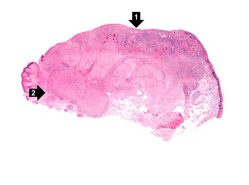 IPLab:Lab 7:Lip SCC - Pathology Education Instructional Resource