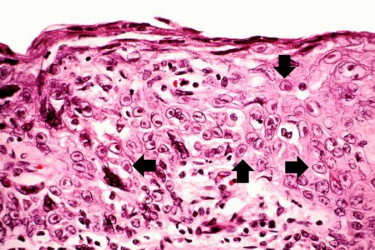 IPLab:Lab 8:HSV Glossitis - Pathology Education Instructional Resource