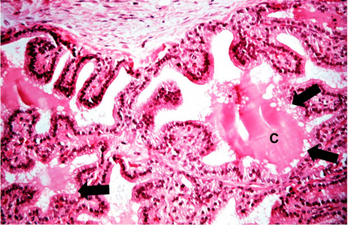 IPLab:Lab 6:Graves Disease - Pathology Education Instructional Resource