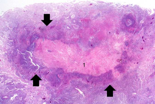 IPLab:Lab 1:Lung Abscess - Pathology Education Instructional Resource