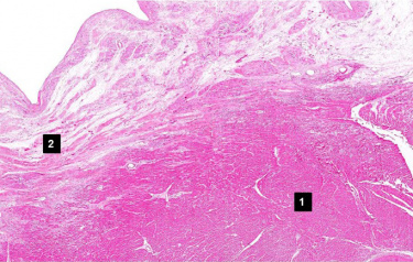 IPLab:Lab 3:Healed Myocardial Infarction - Pathology Education ...