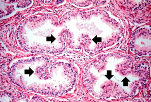IPLab:Lab 2:Hyperplasia - Pathology Education Instructional Resource