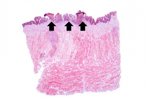 IPLab:Lab 8:HSV Glossitis - Pathology Education Instructional Resource