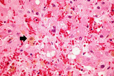 IPLab:Lab 4:Chronic Passive Congestion - Pathology Education ...