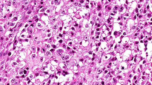 IPLab:Lab 7:Osteosarcoma - Pathology Education Instructional Resource