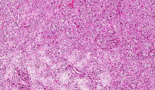 IPLab:Lab 7:Osteosarcoma - Pathology Education Instructional Resource