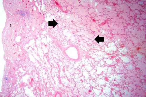 IPLab:Lab 4:Pulmonary Congestion and Edema - Pathology Education ...