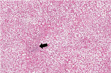 IPLab:Lab 2:Fatty Change and Cirrhosis - Pathology Education ...
