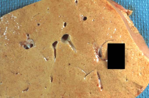 IPLab:Lab 2:Fatty Change and Cirrhosis - Pathology Education ...