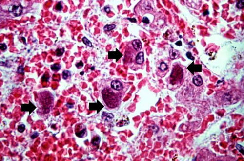 IPLab:Lab 8:Hepatitis B - Pathology Education Instructional Resource