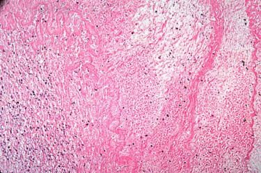 IPLab:Lab 4:Mural Thrombus - Pathology Education Instructional Resource