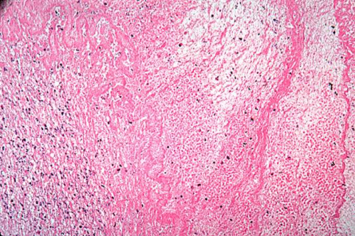 IPLab:Lab 4:Mural Thrombus - Pathology Education Instructional Resource