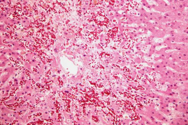 IPLab:Lab 4:Chronic Passive Congestion - Pathology Education ...