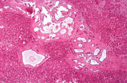 IPLab:Lab 5:Polycystic Kidney Disease - Pathology Education ...
