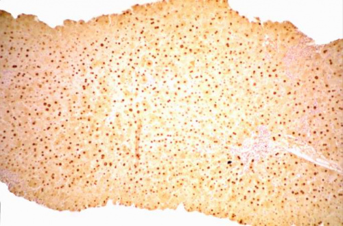 IPLab:Lab 8:Hepatitis B - Pathology Education Instructional Resource