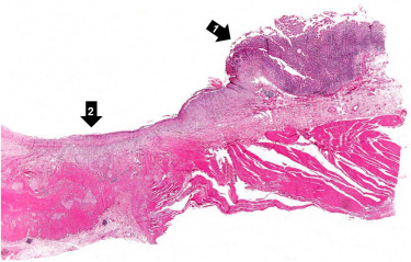 IPLab:Lab 3:Chronic Peptic Ulcer - Pathology Education Instructional ...
