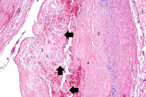 IPLab:Lab 4:Thrombosis - Pathology Education Instructional Resource
