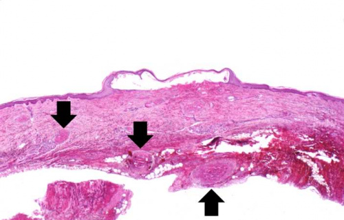 IPLab:Lab 12:Acetaminophen Toxicity - Pathology Education Instructional ...