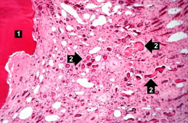 IPLab:Lab 5:Polycystic Kidney Disease - Pathology Education ...