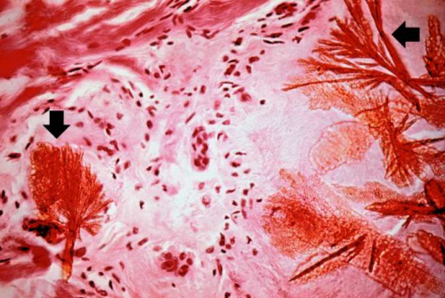 IPLab:Lab 5:Gout - Pathology Education Instructional Resource