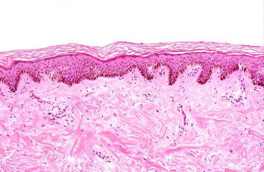 IPLab:Lab 12:Burns - Pathology Education Instructional Resource