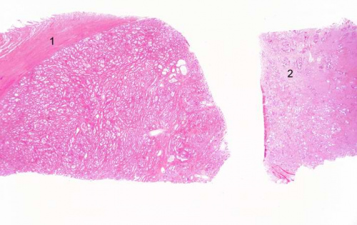 IPLab:Lab 2:Hyperplasia - Pathology Education Instructional Resource
