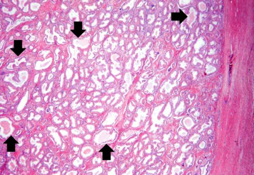 IPLab:Lab 2:Hyperplasia - Pathology Education Instructional Resource