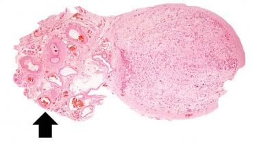 IPLab:Lab 2:Atrophy - Pathology Education Instructional Resource