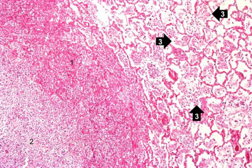 IPLab:Lab 3:Bronchopneumonia - Pathology Education Instructional Resource