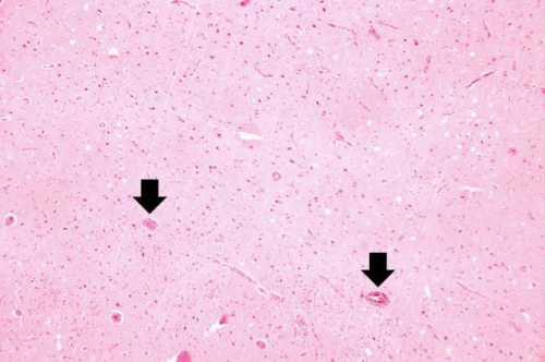 IPLab:Lab 8:HSV Encephalitis - Pathology Education Instructional Resource