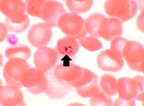 IPLab:Lab 11:Malaria - Pathology Education Instructional Resource