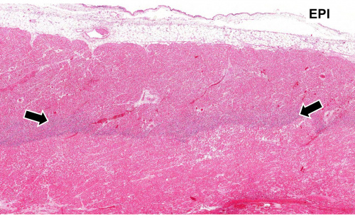 IPLab:Lab 3:Acute Myocardial Infarction - Pathology Education ...