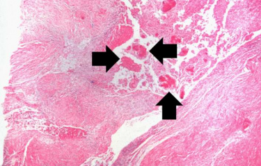 IPLab:Lab 9:Actinomycosis - Pathology Education Instructional Resource