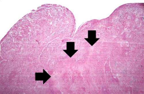 IPLab:Lab 10:Histoplasmosis - Pathology Education Instructional Resource