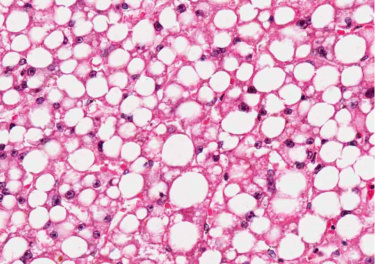 IPLab:Lab 2:Fatty Change and Cirrhosis - Pathology Education ...