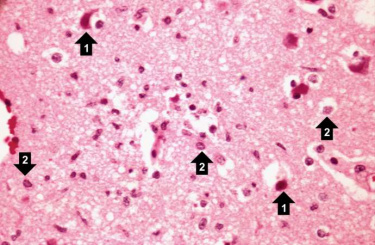 IPLab:Lab 8:HSV Encephalitis - Pathology Education Instructional Resource