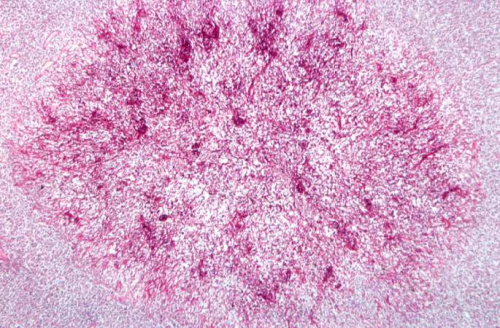 IPLab:Lab 10:Candidiasis - Pathology Education Instructional Resource