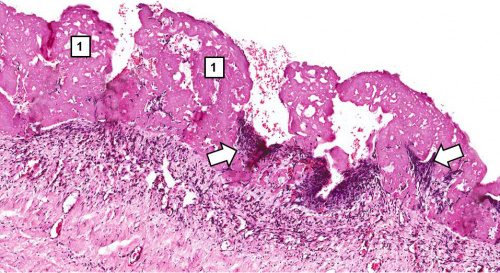 IPLab:Lab 3:Fibrinous Pericarditis - Pathology Education Instructional ...