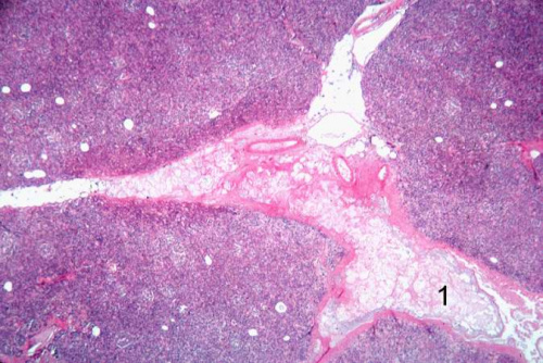 IPLab:Lab 1:Fat Necrosis - Pathology Education Instructional Resource